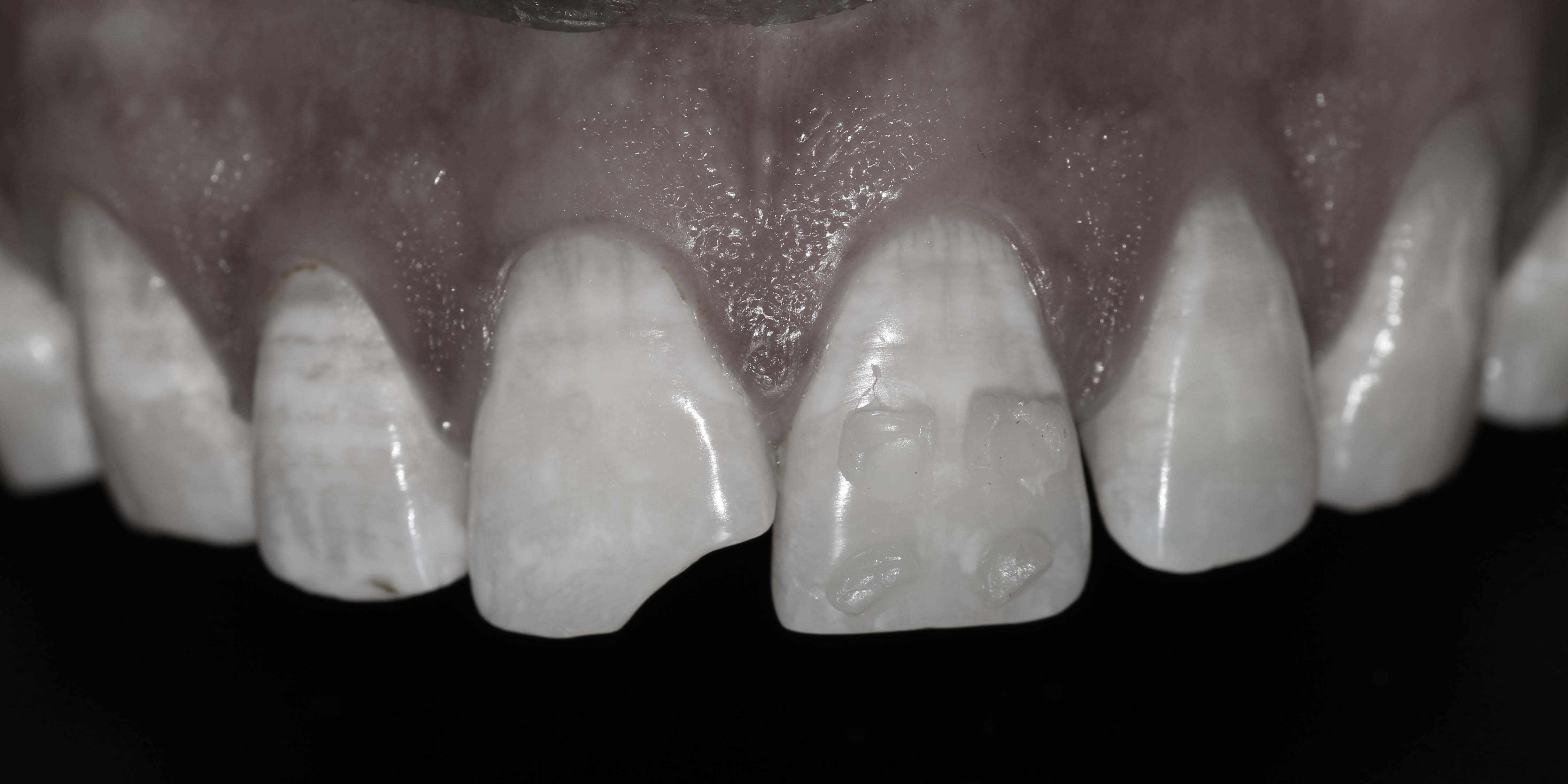 DT News - India - Developing tight proximal contacts in anterior teeth ...