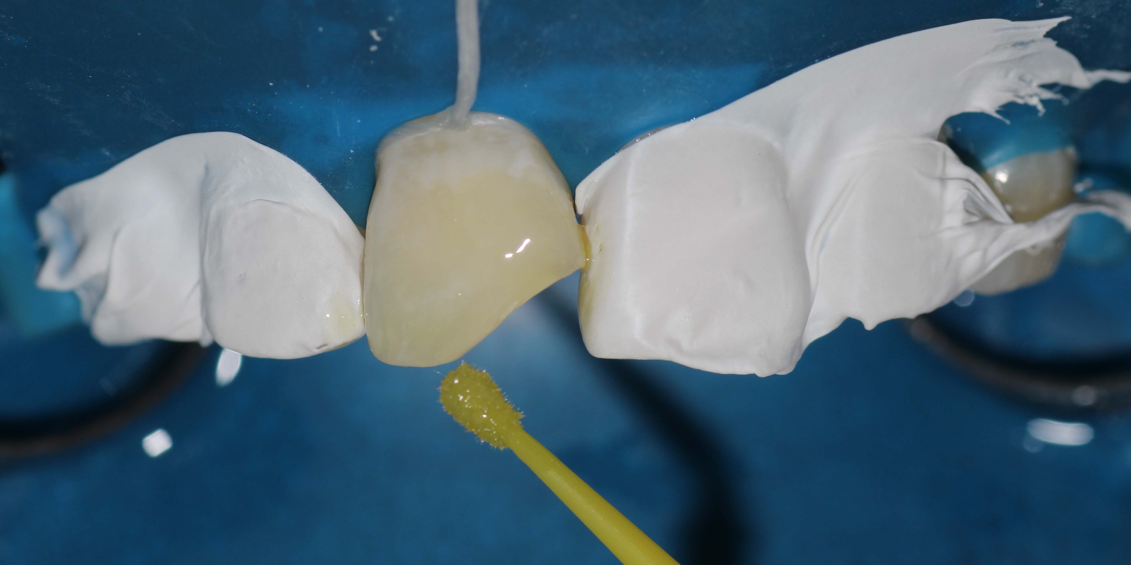 DT News - India - Developing tight proximal contacts in anterior teeth ...