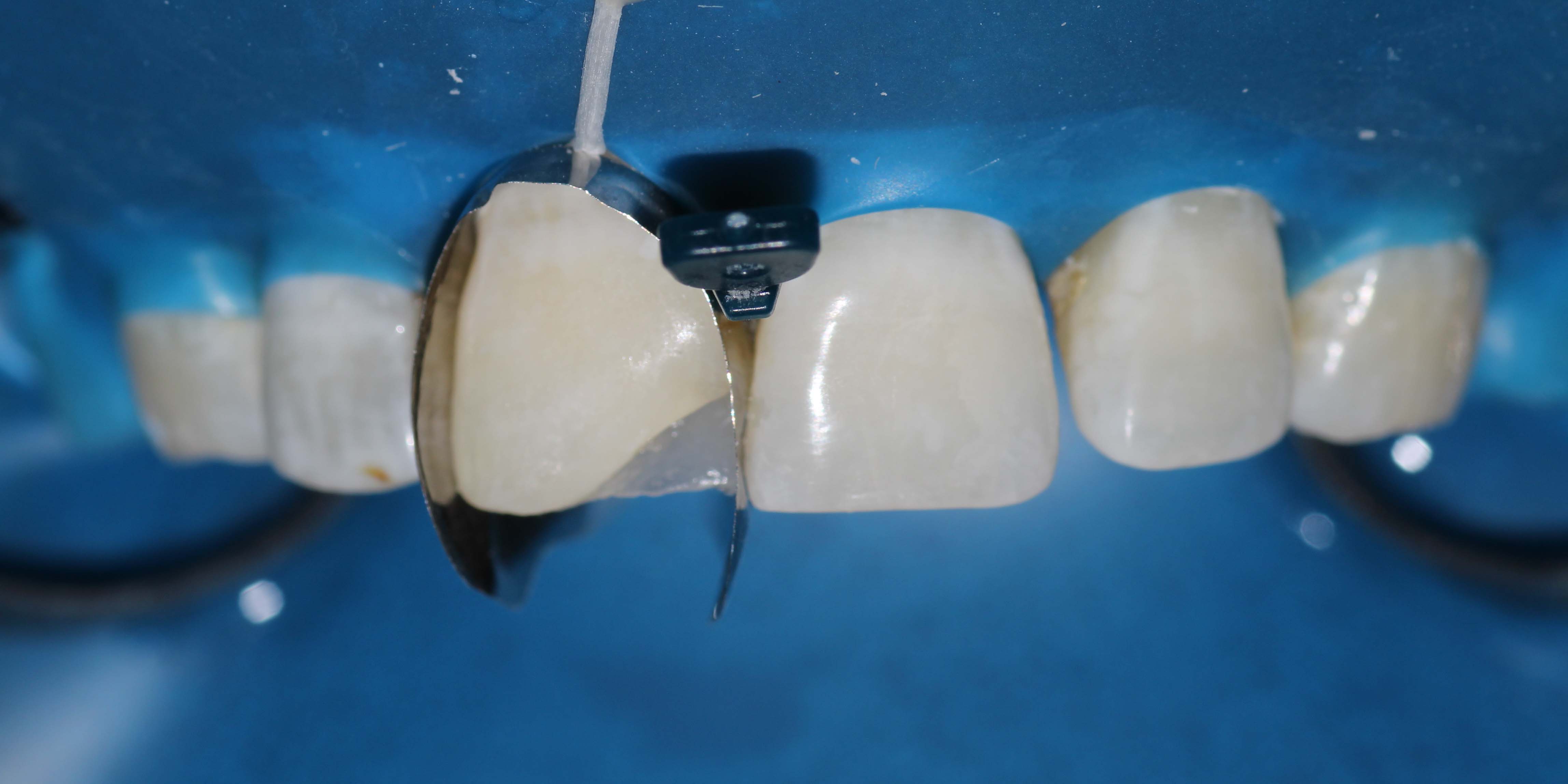DT News - India - Developing tight proximal contacts in anterior teeth ...