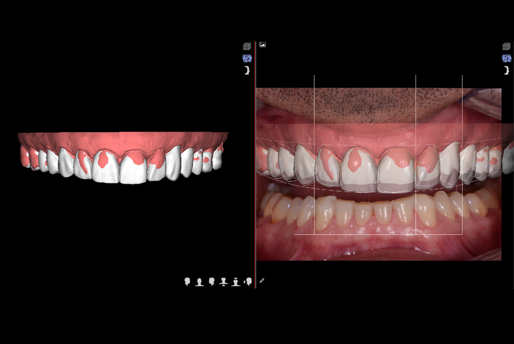 Dental News - Correction of VDO: Fully digital workflow, integration of ...