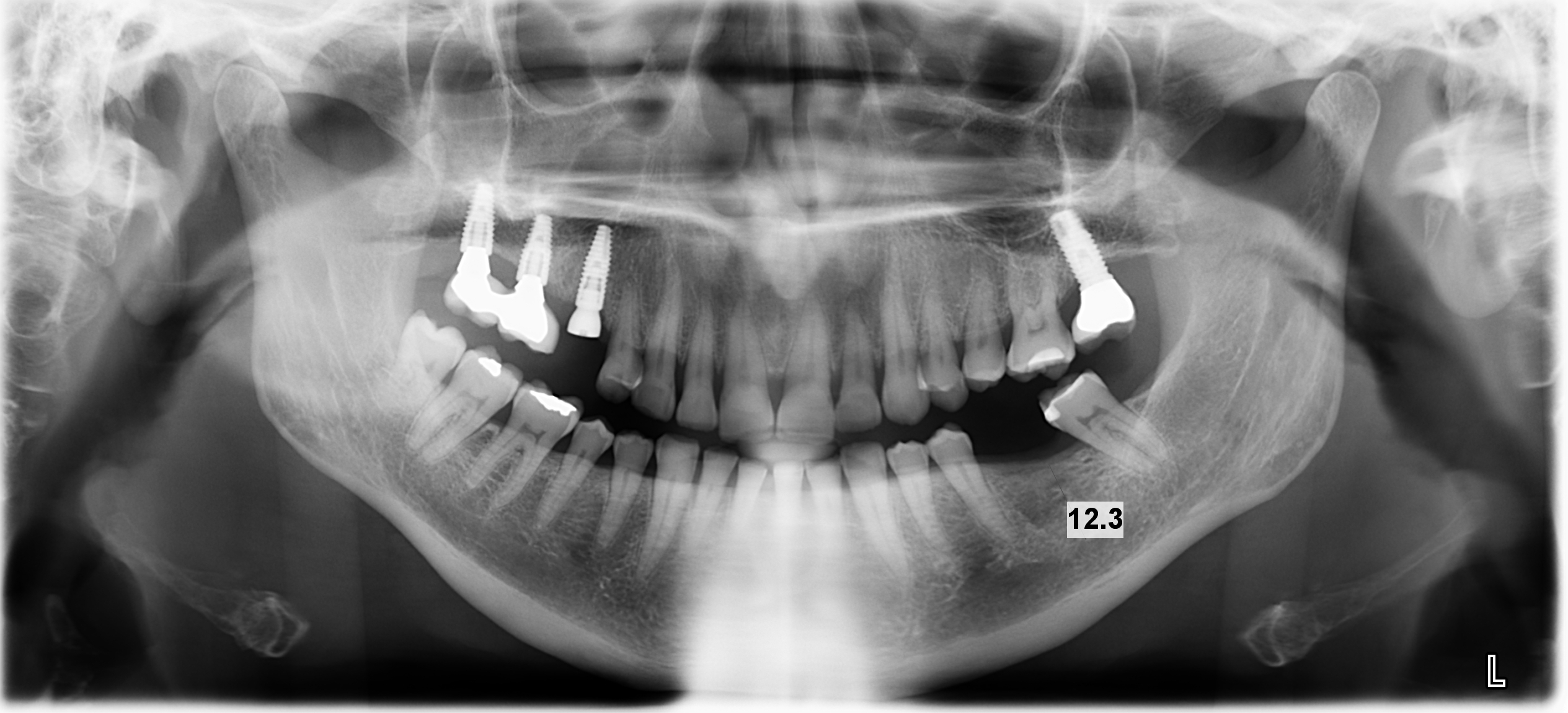 Dental News - Conventional and immediate loading with final n!ce screw ...