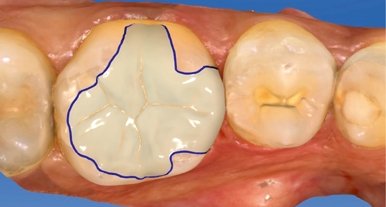DT News - MEA - Easy and efficient: Composite resin blocks for the CAD ...
