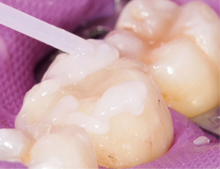 DT News - MEA - Easy and efficient: Composite resin blocks for the CAD ...