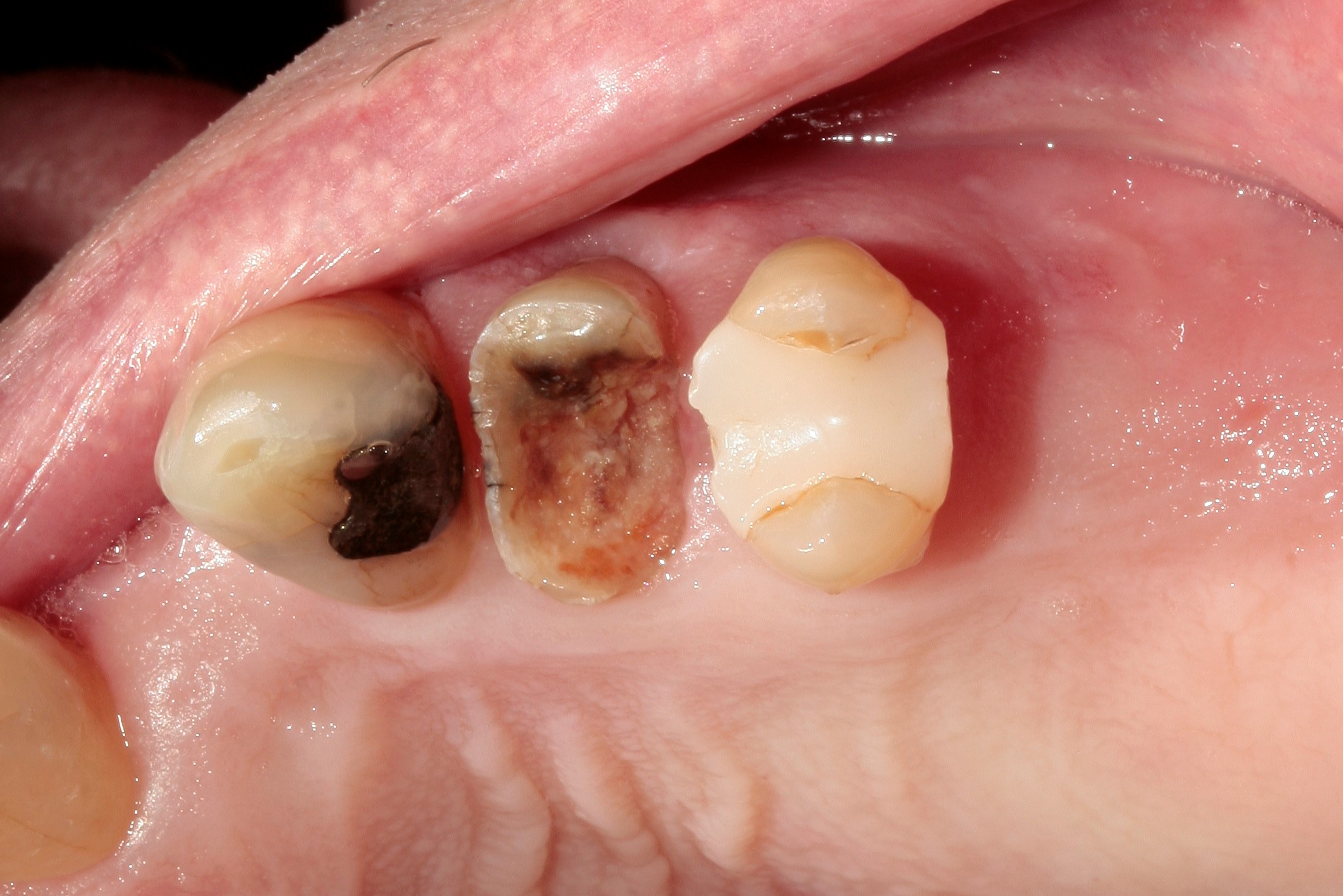 Dental News - Atraumatic extraction of maxillary first premolar