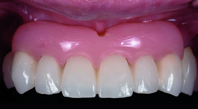 DT News - MEA - Customised aesthetics for provisional profile ...