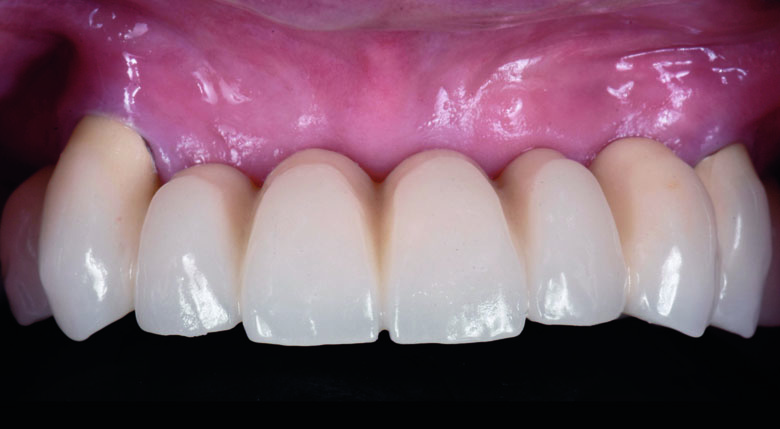 DT News - MEA - Customised aesthetics for provisional profile ...