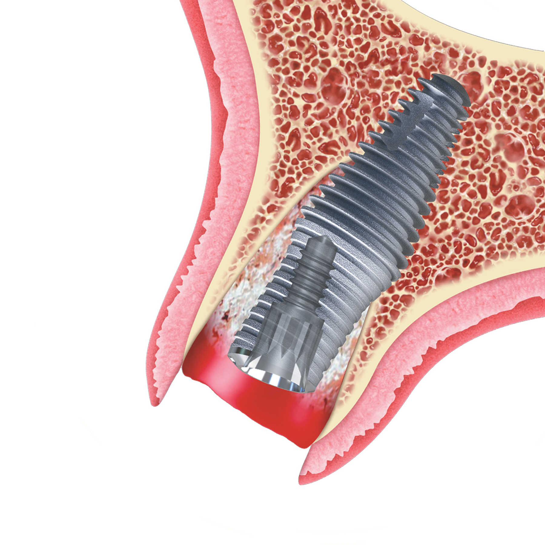 Southern Implants lance l’INVERTA en France