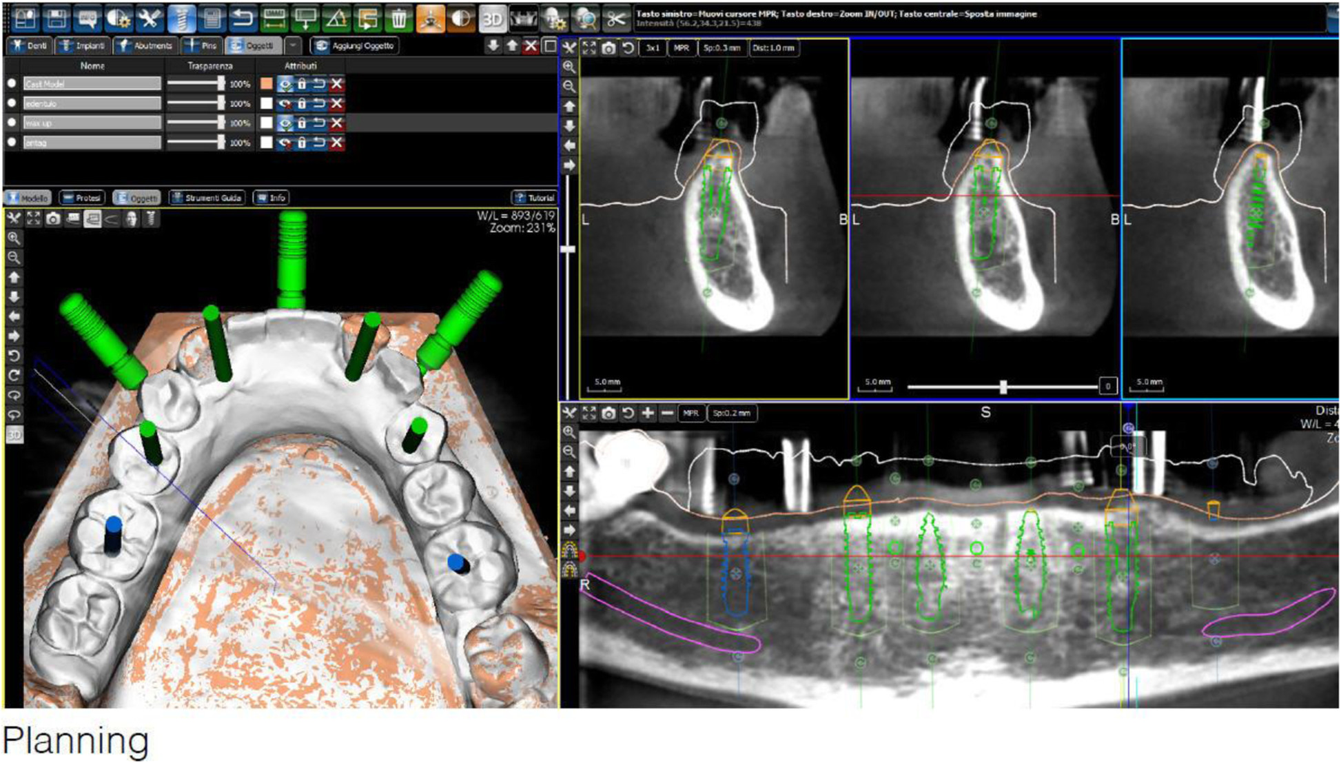 Dental News - Computer-aided, template-guided immediate implant ...