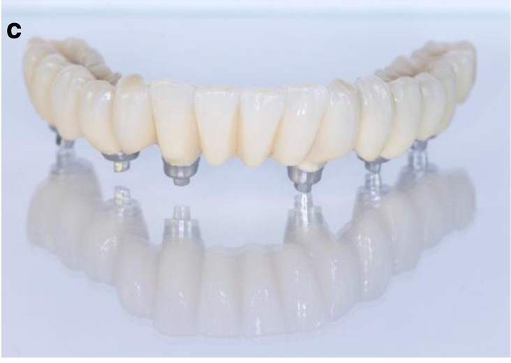 Dental News - Computer-aided, template-guided immediate implant ...