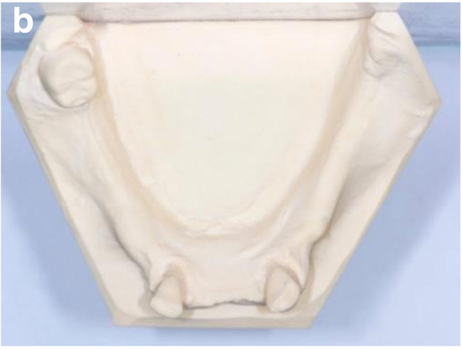 Dental News - Computer-aided, template-guided immediate implant ...