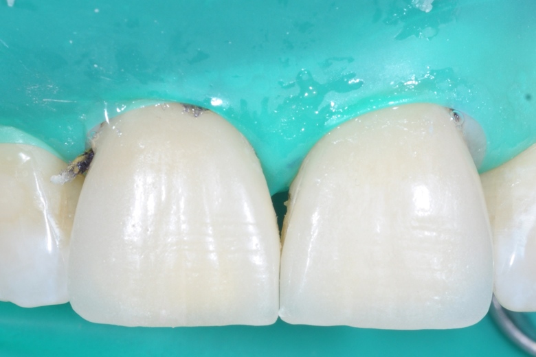 Dental restoration of central incisors with PAVAVIA V5