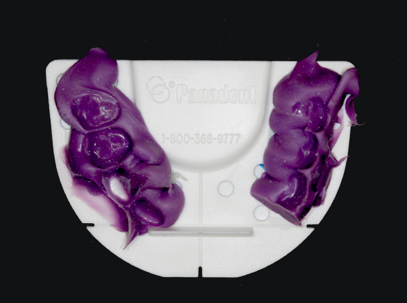 Dental News - Digital face-bow transfer technique dentofacial analyser ...