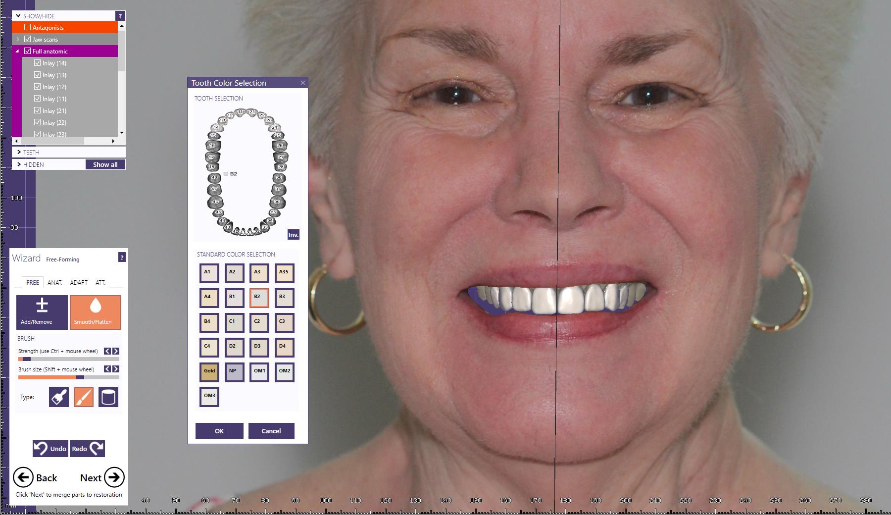 Dental News - Digital face-bow transfer technique dentofacial analyser ...