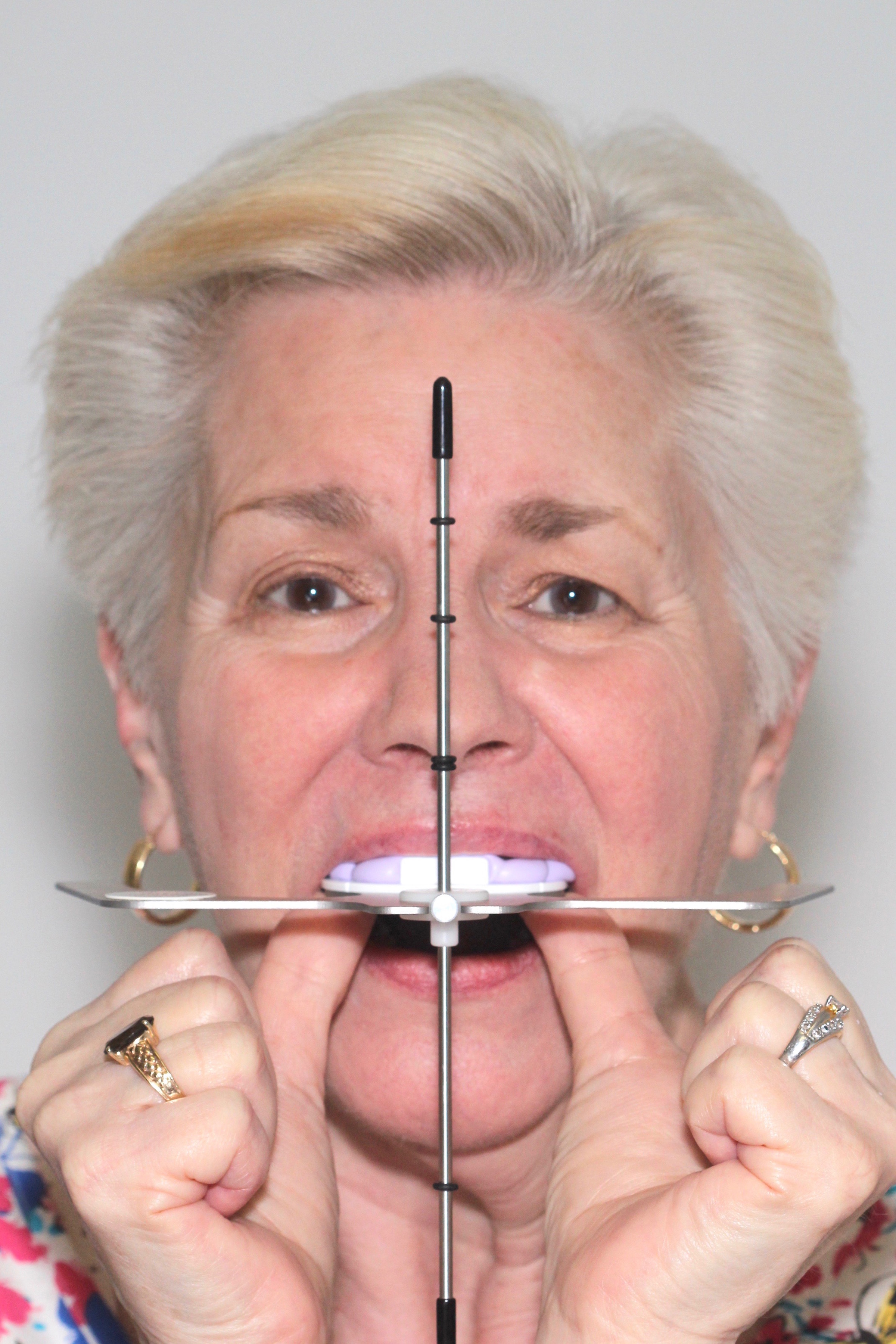 Dental News - Digital face-bow transfer technique dentofacial analyser for dental aesthetics