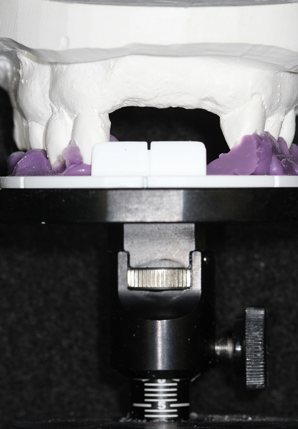 Dental News - Digital face-bow transfer technique dentofacial analyser ...