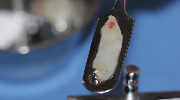 DT News - MEA - Platelets Rich Fibrin (Prf)–horizontal reconstruction ...