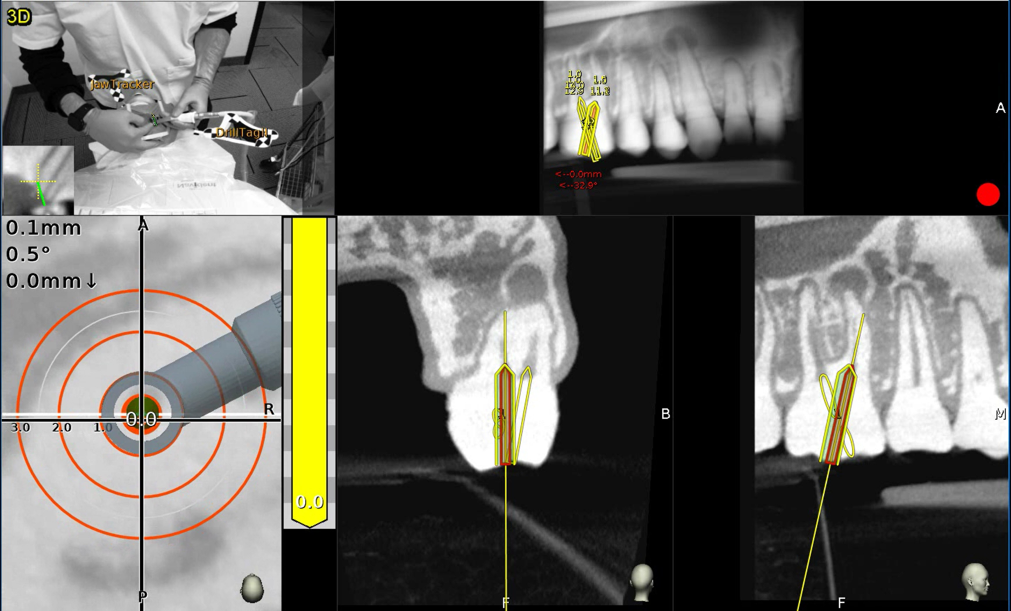Dental News - Dynamic navigation—The future of minimally invasive ...