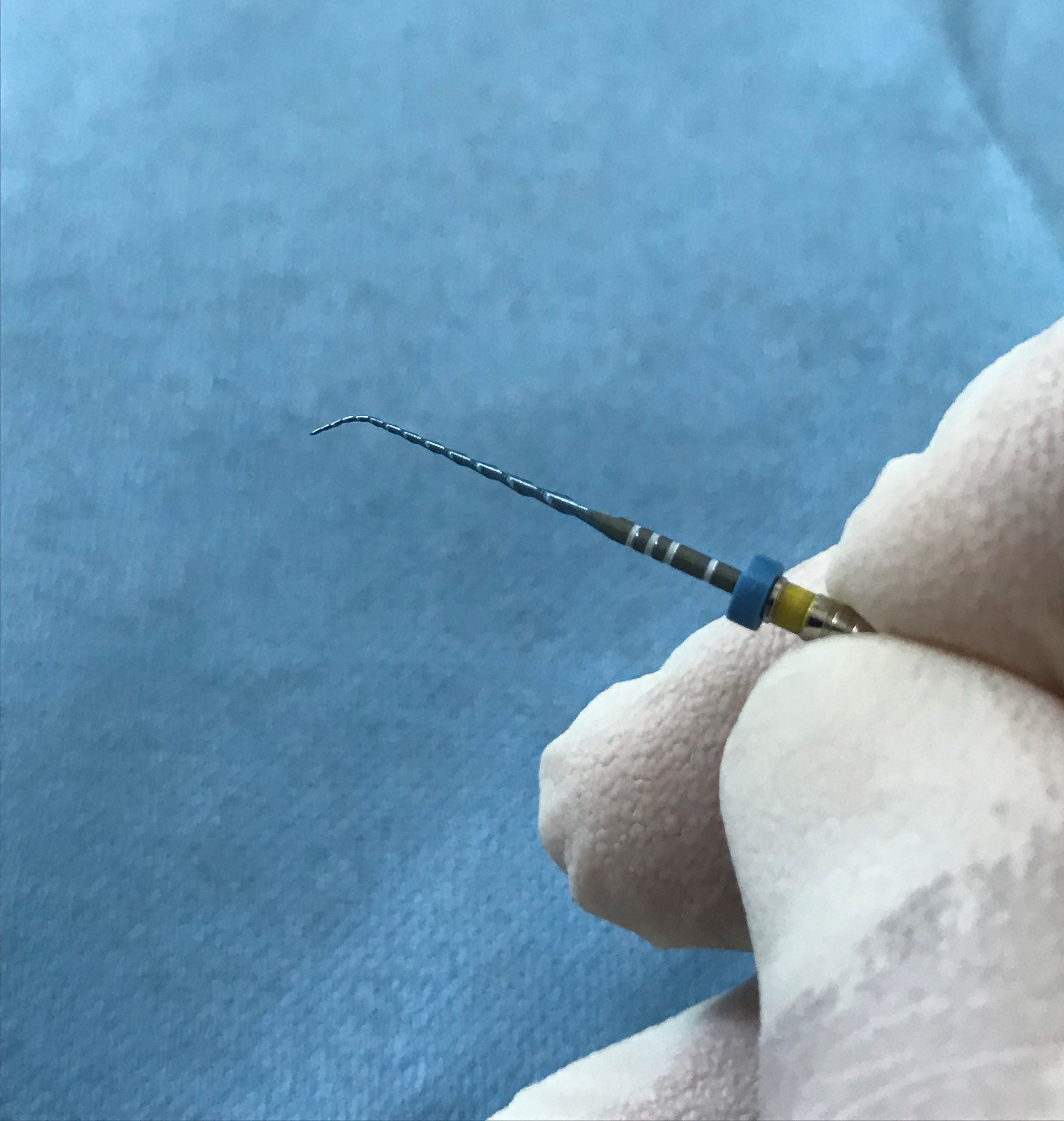 Dental News - Shaping a Type V mandibular premolar with VDW.ROTATE