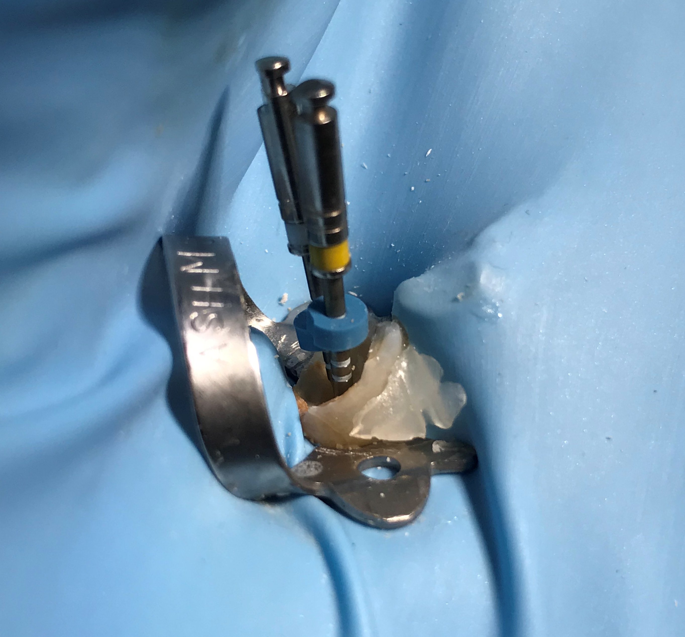 Dental News - Shaping a Type V mandibular premolar with VDW.ROTATE