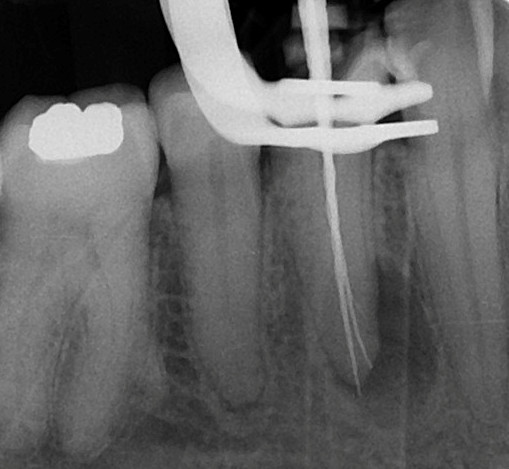 Dental News - Shaping a Type V mandibular premolar with VDW.ROTATE