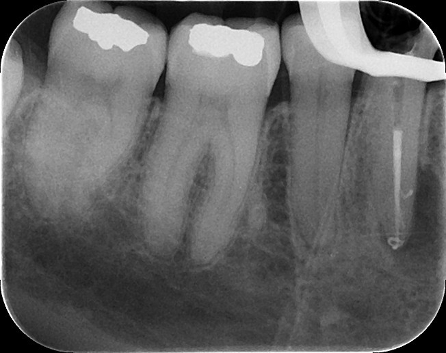Dental News - Shaping a Type V mandibular premolar with VDW.ROTATE