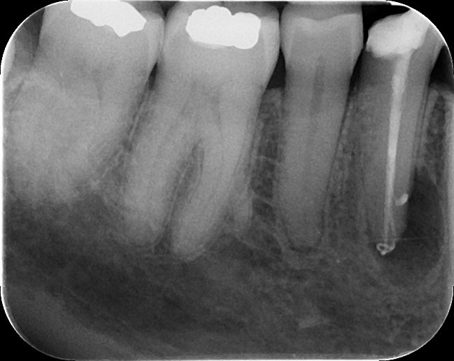 Dental News - Shaping a Type V mandibular premolar with VDW.ROTATE