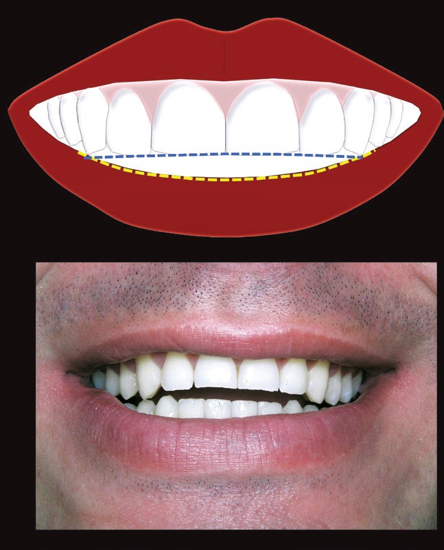 DT News - India - Correction of a Reverse Smile Line – Turning back the ...