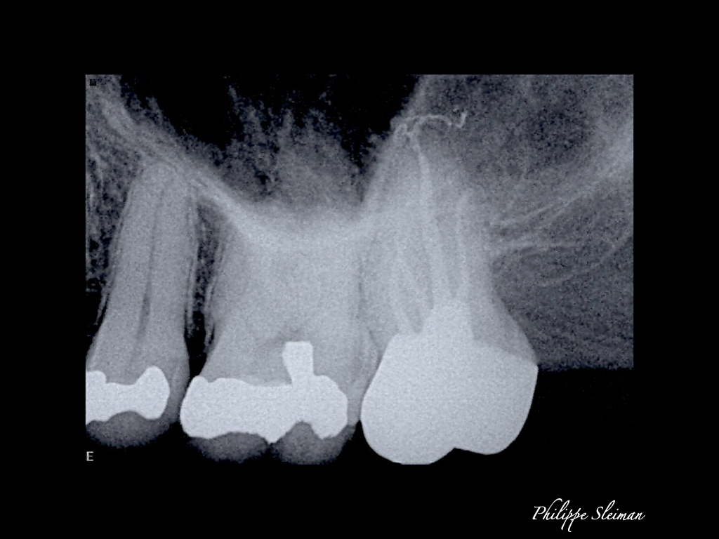 Dental News - Clinical management of maxillary second molar root canal ...