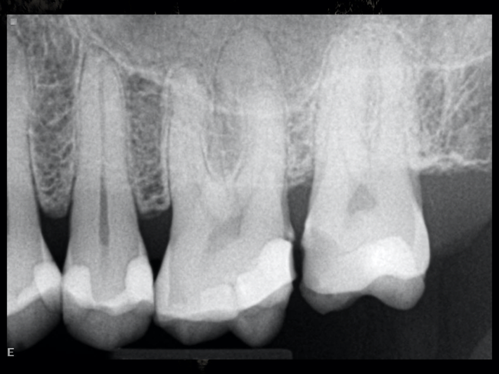 Dental News - Clinical management of maxillary second molar root canal ...