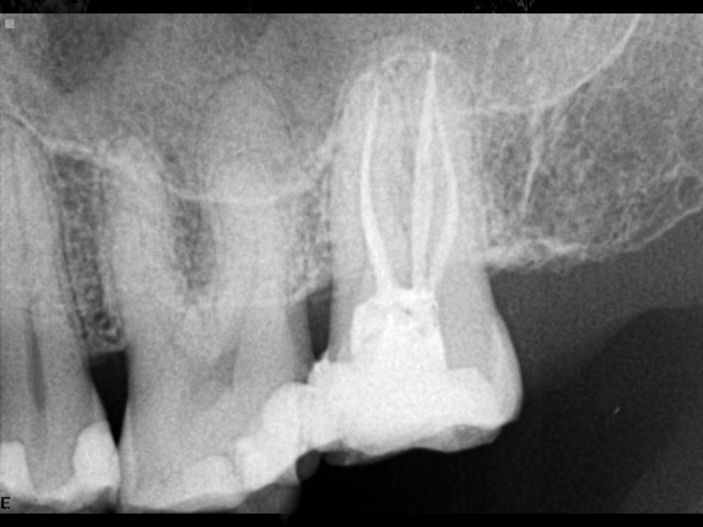 Dental News - Clinical management of maxillary second molar root canal ...