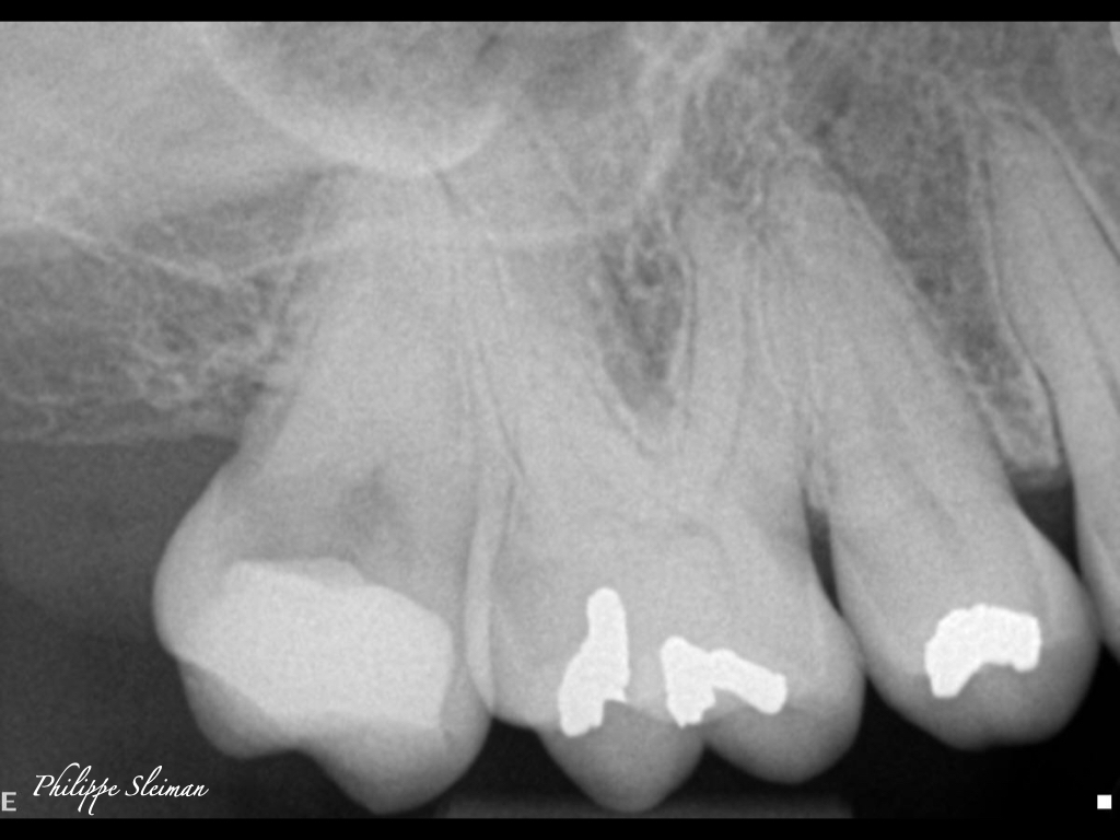 Dental News - Clinical management of maxillary second molar root canal ...