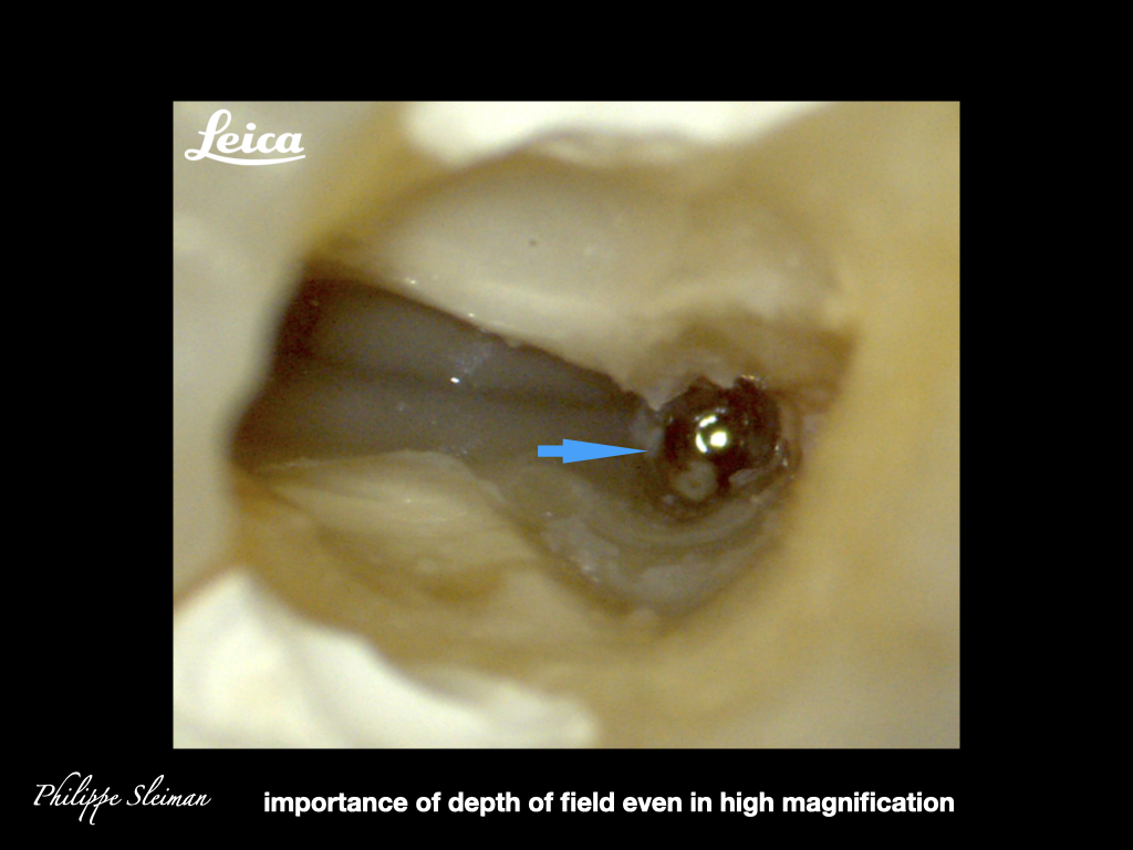 Dental News - Clinical management of maxillary second molar root canal ...