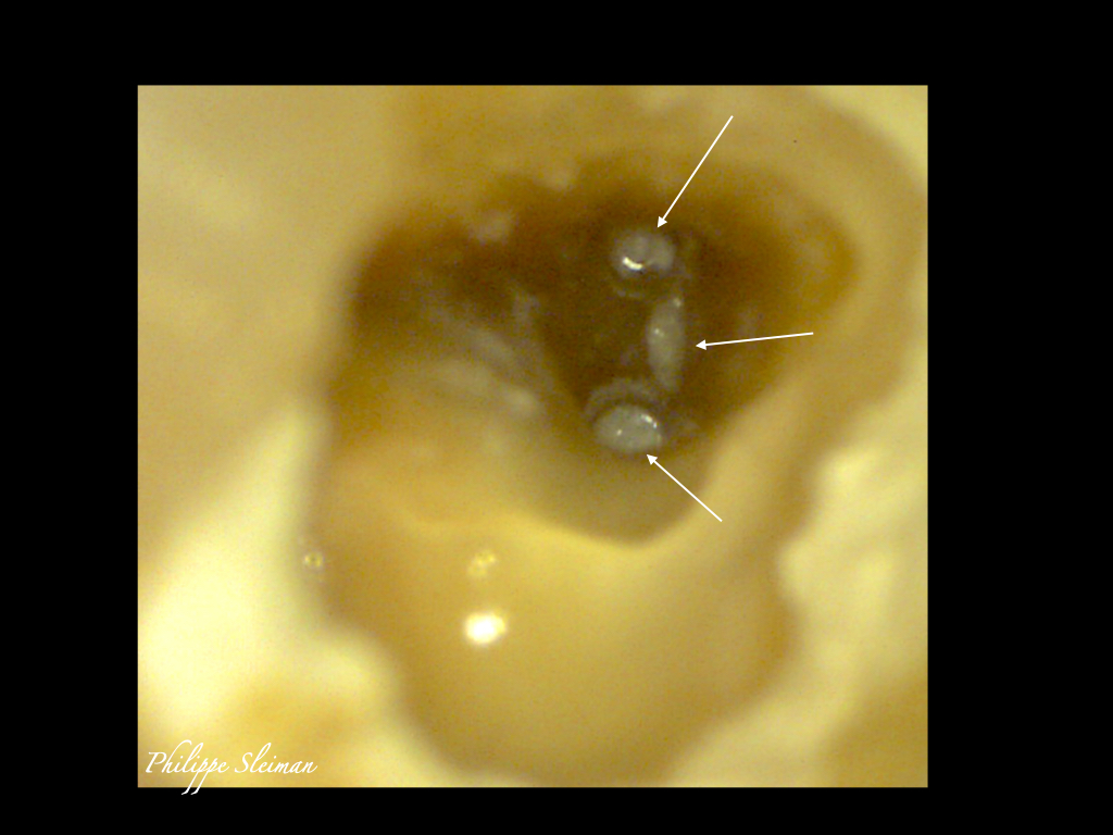 Dental News - Clinical management of maxillary second molar root canal ...