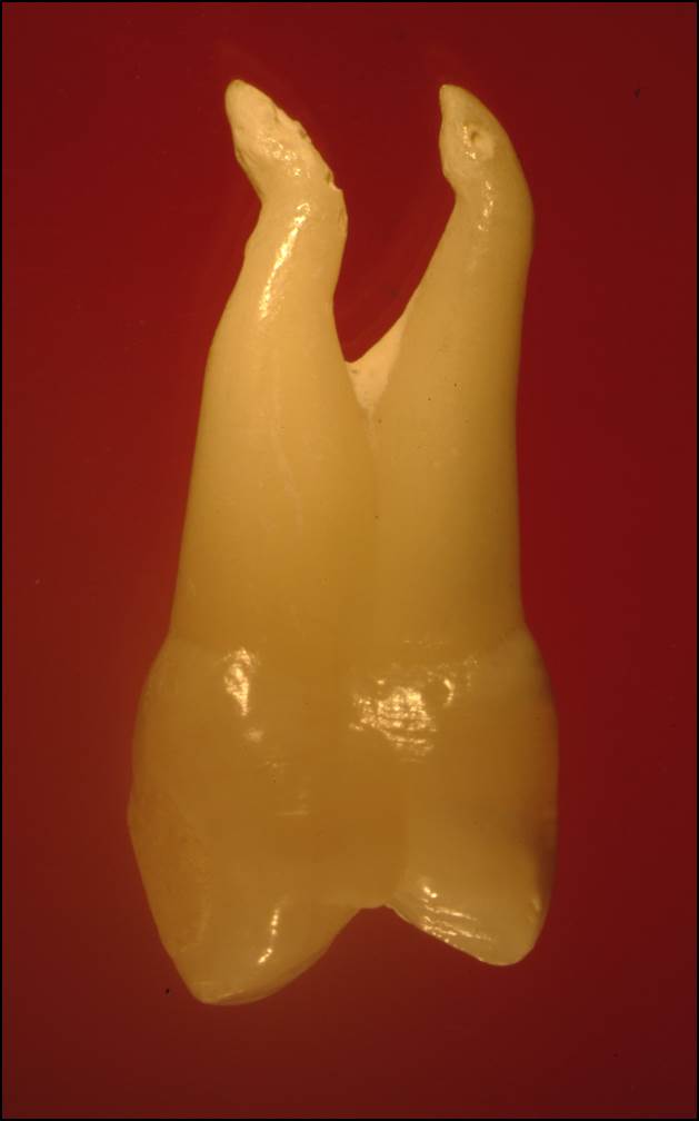 Buccal root of the bifurcated maxillary premolar—a danger zone during ...