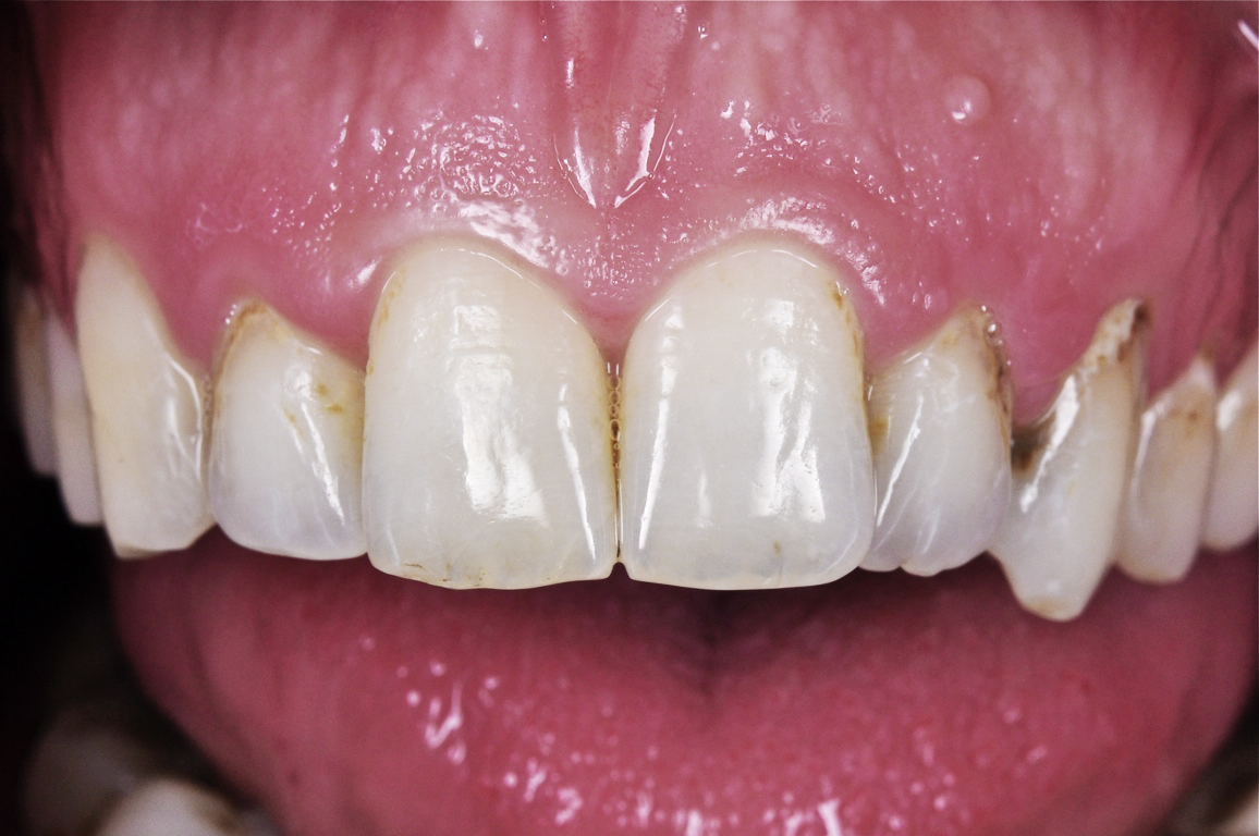 DT News - MEA - The next generation of the composite veneering system