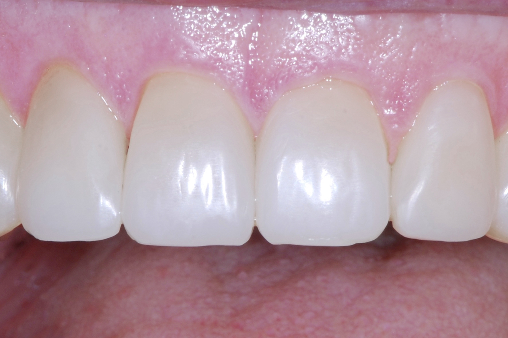 DT News - MEA - The next generation of the composite veneering system