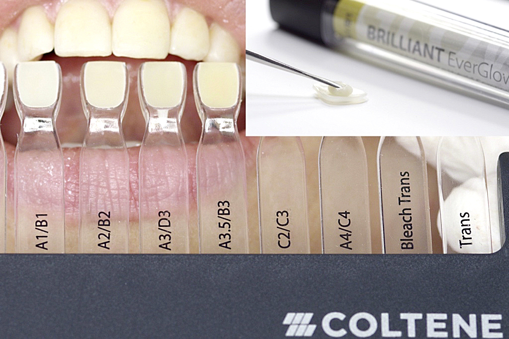 DT News - MEA - The next generation of the composite veneering system