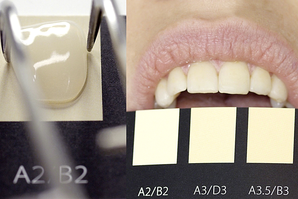 DT News - MEA - The next generation of the composite veneering system