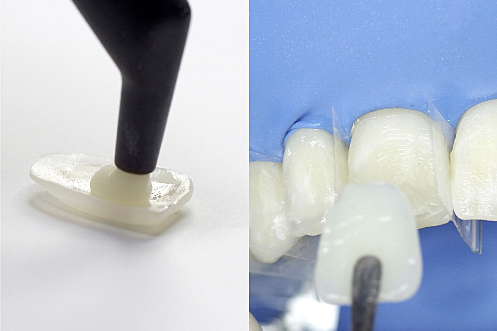 DT News - MEA - The next generation of the composite veneering system