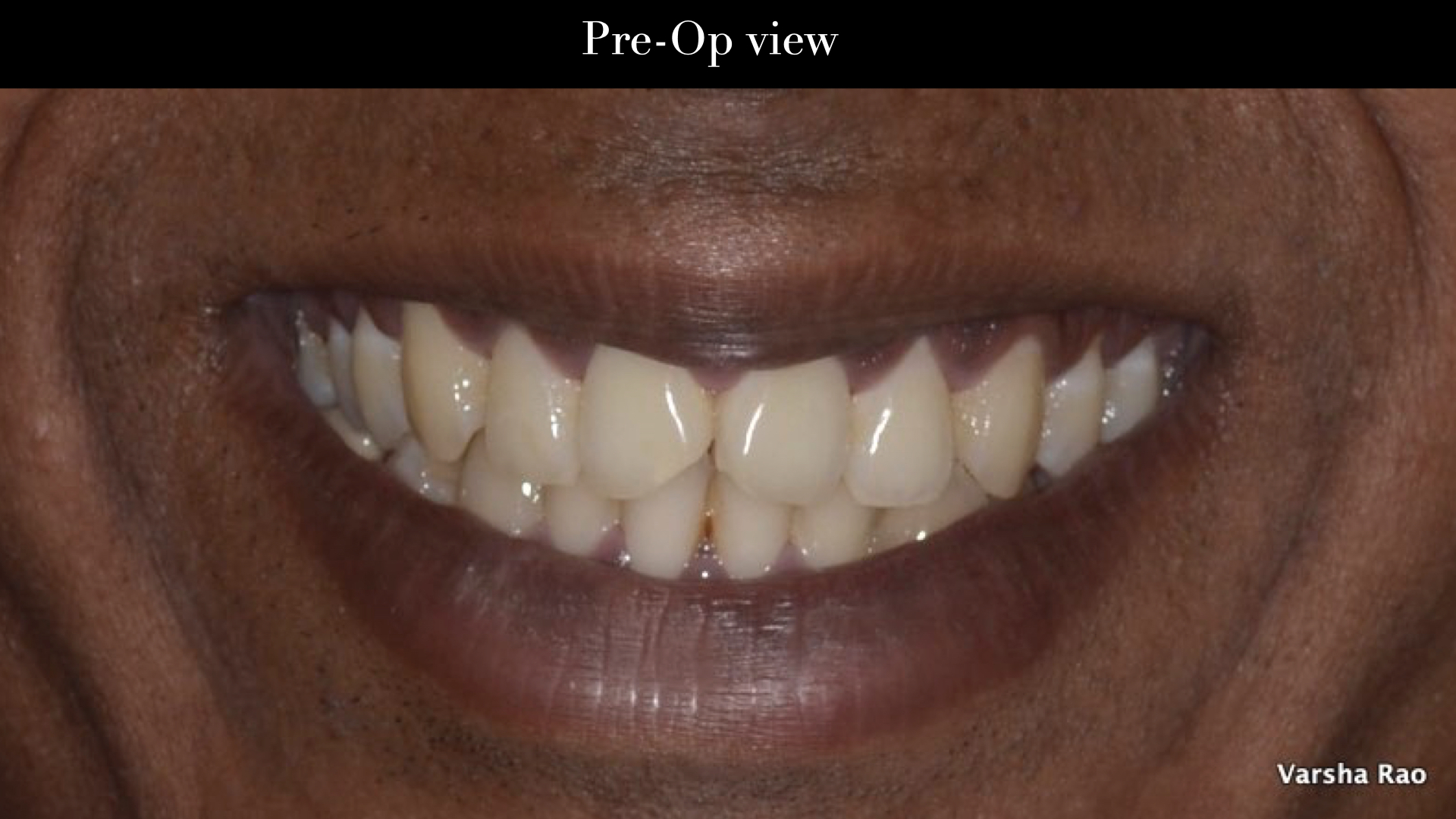 Class 4 Build-up in Adjacent Teeth Using Modified Putty Technique: Dr ...