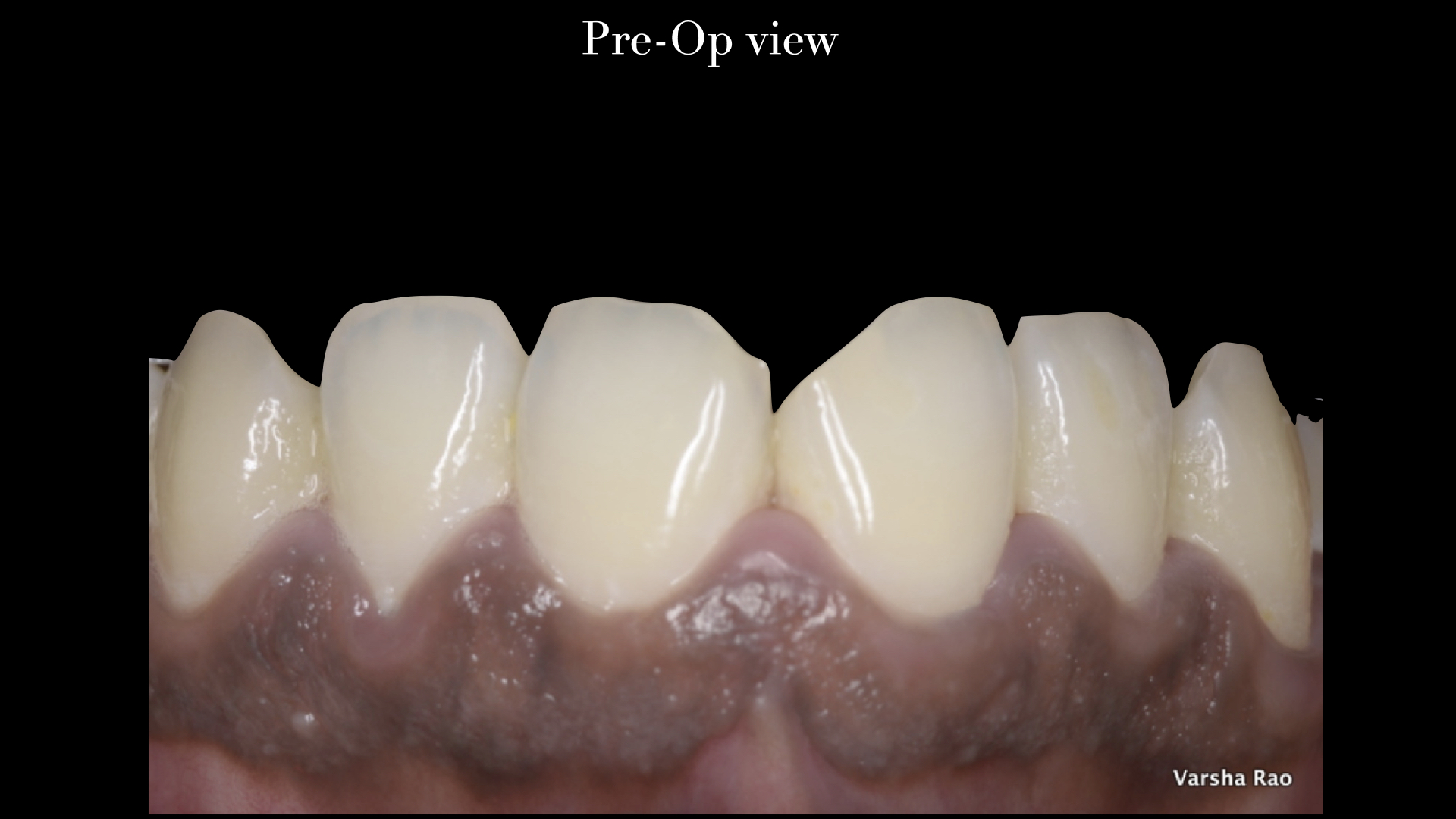 Class 4 Build-up in Adjacent Teeth Using Modified Putty Technique: Dr ...