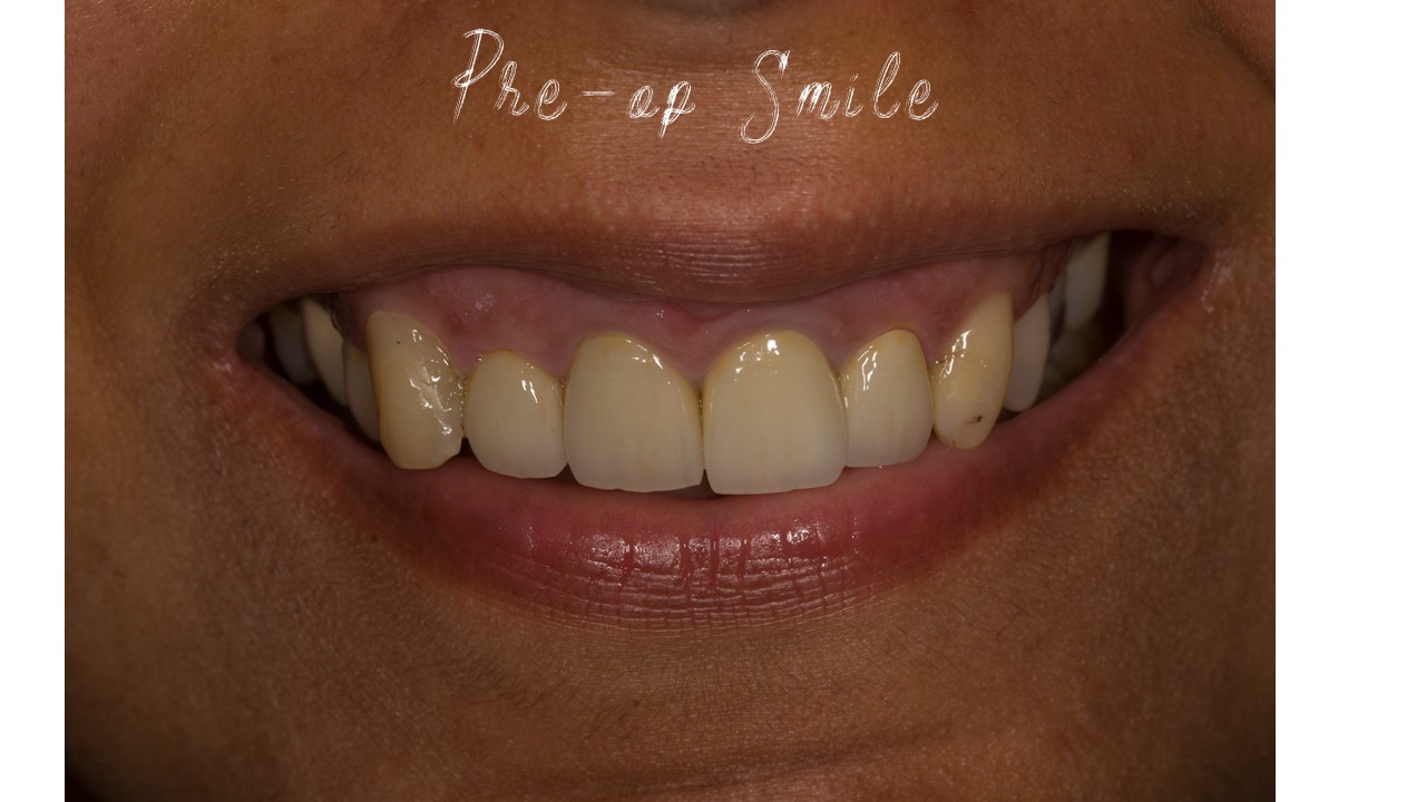 Saving Seemingly Hopeless Teeth In Aesthetic Zone: Team Approach : Dr ...