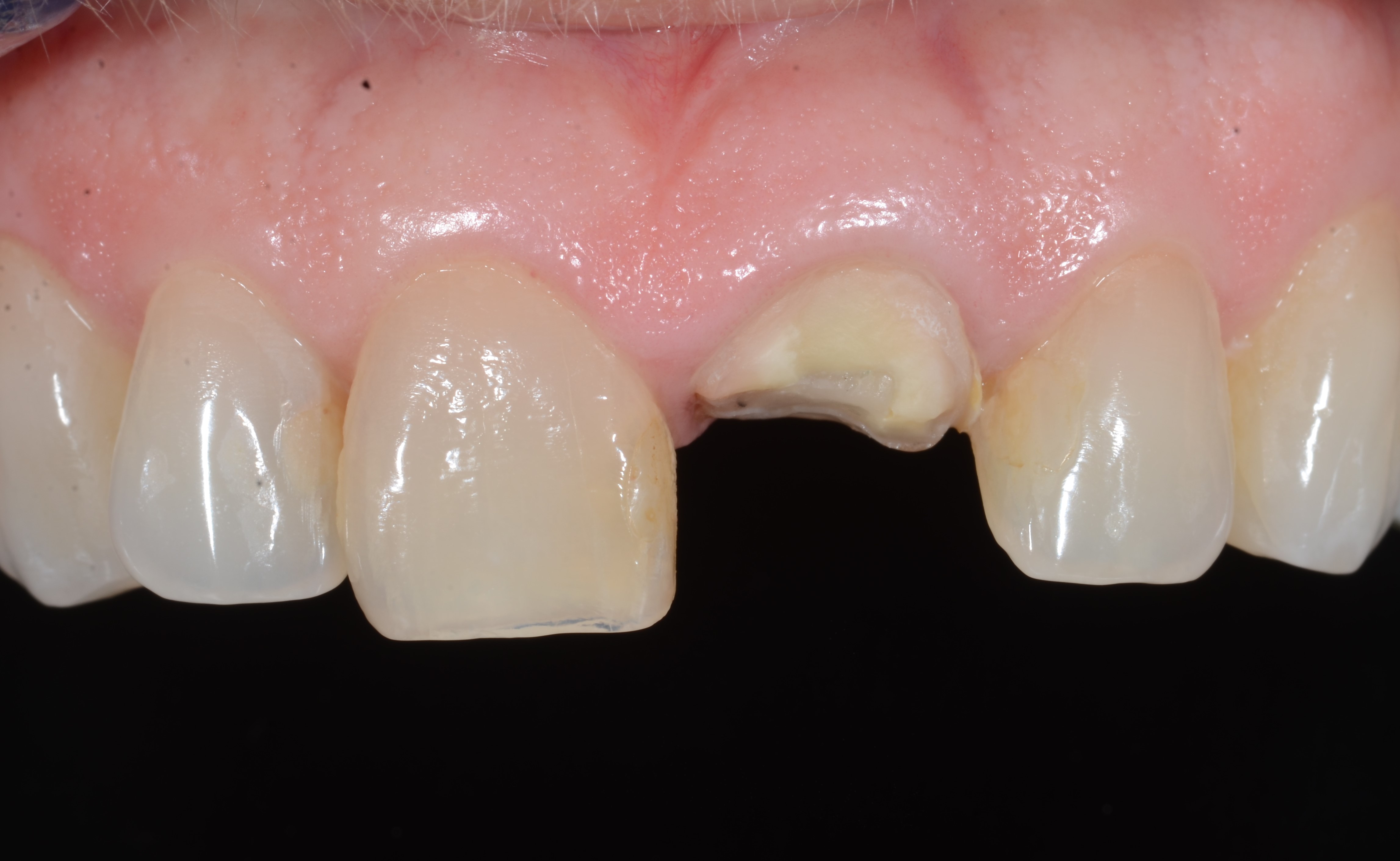Immediate implant placement and restoration in fractured incisor with ...