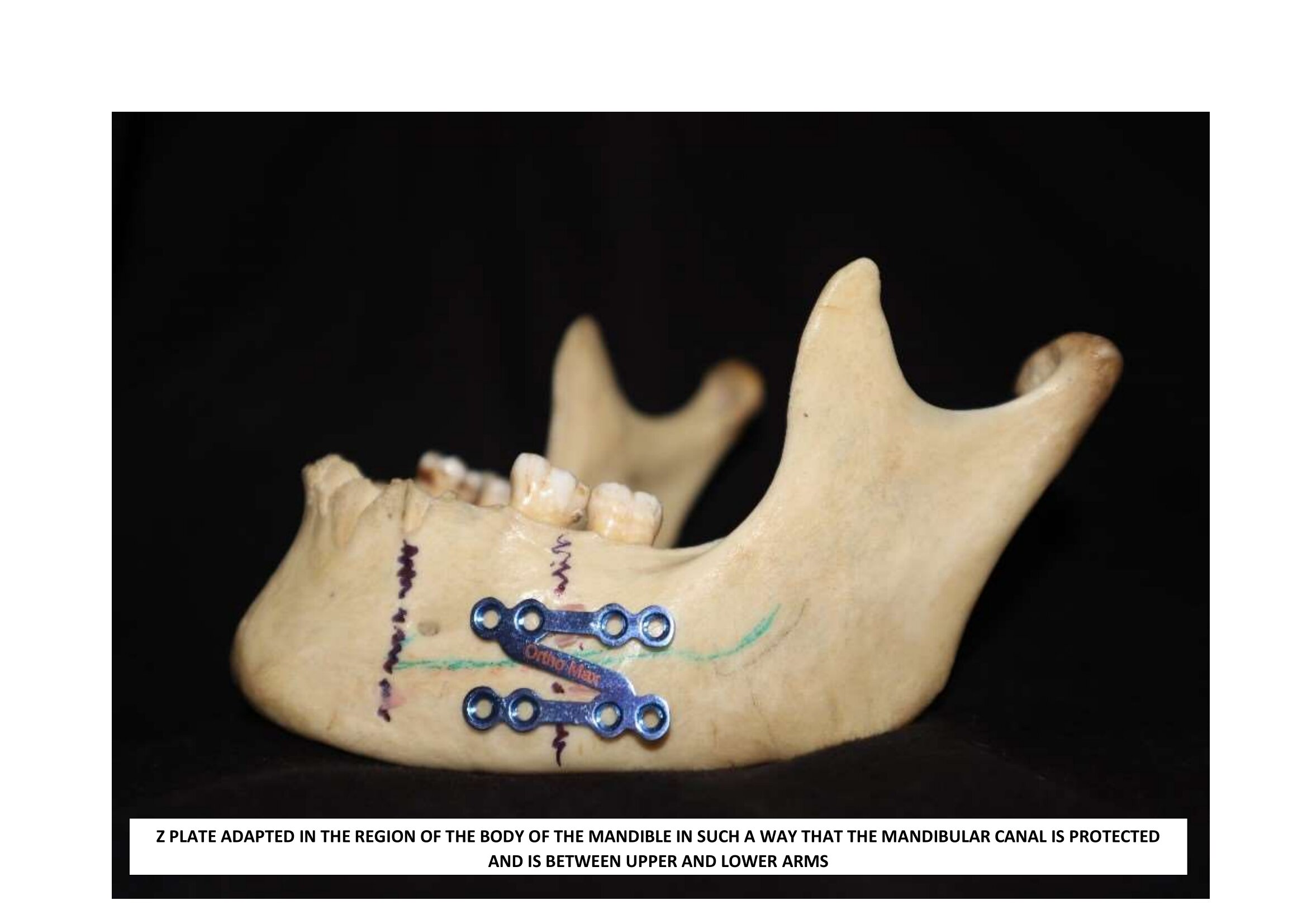 DT News - India - "Z-plate for mandibular fractures"- Design patent for ...