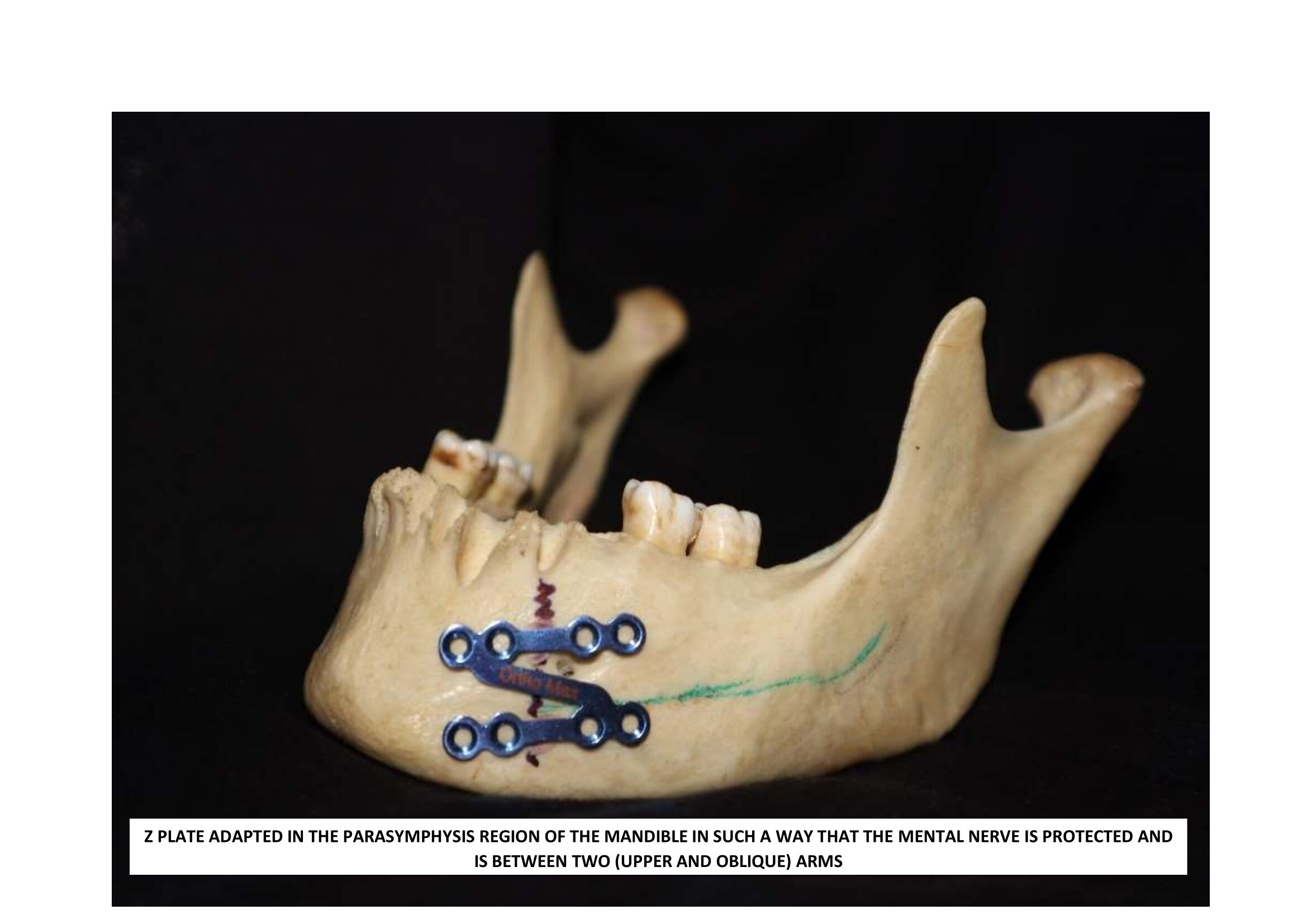 DT News - India - "Z-plate for mandibular fractures"- Design patent for ...
