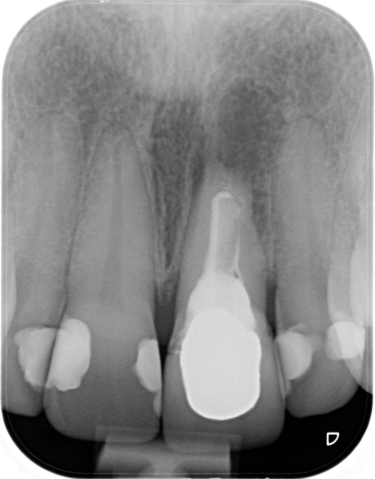 Dental News - Single-tooth restoration using an all-ceramic implant ...