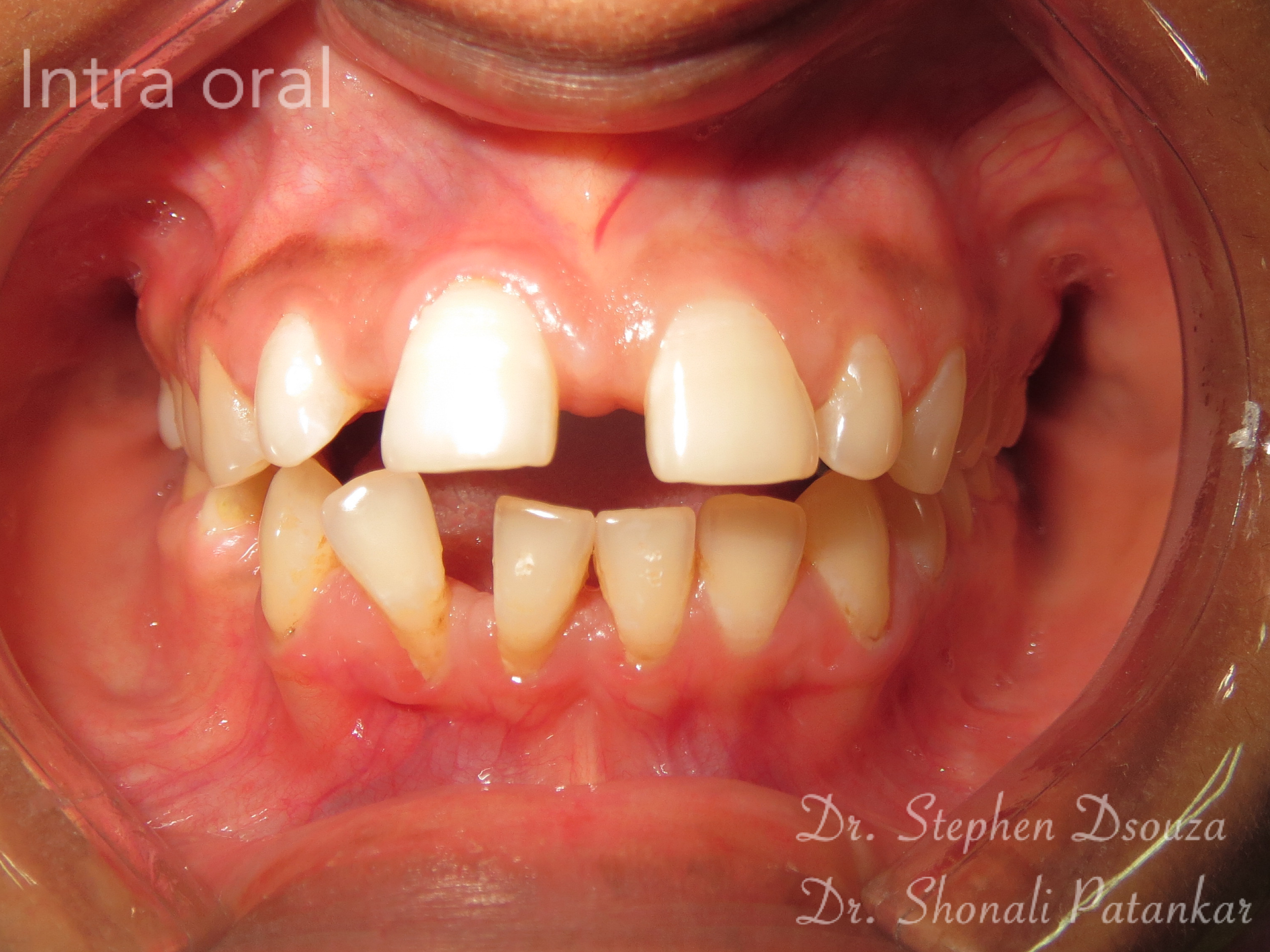 DT News - India - A minimally invasive smile makeover: an orthodontic ...