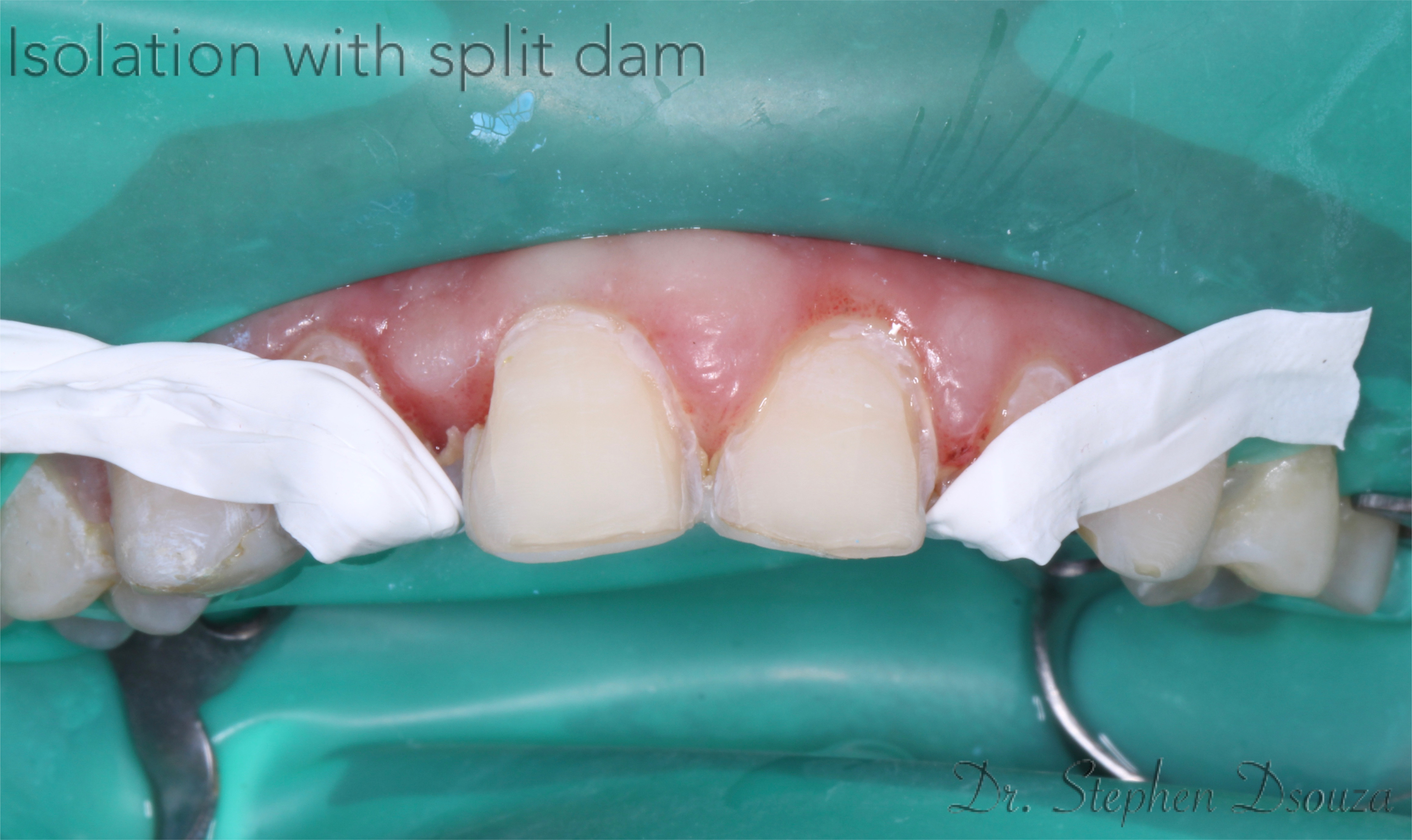 DT News - India - A minimally invasive smile makeover: an orthodontic ...