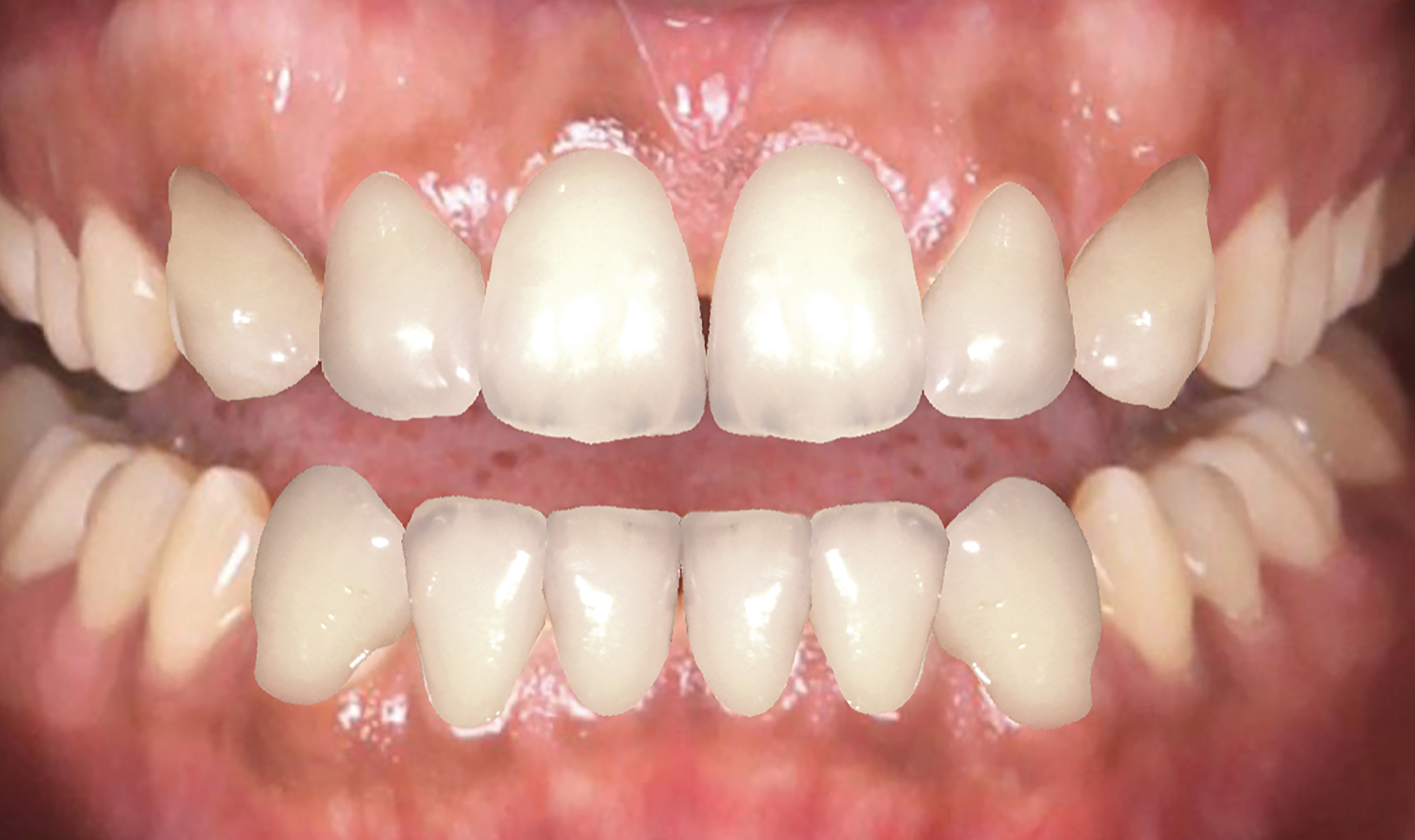 DT News - Nordic - Veneer restoration: Calibrated preparation to close ...