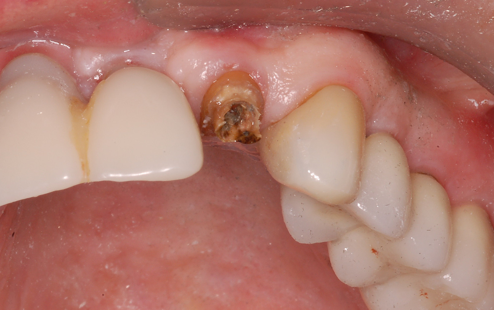 Use of a decalcified cortical bone plate to aid in lateral ridge ...